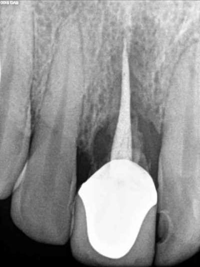 Resorption2 zy5fv2 - Eugenol