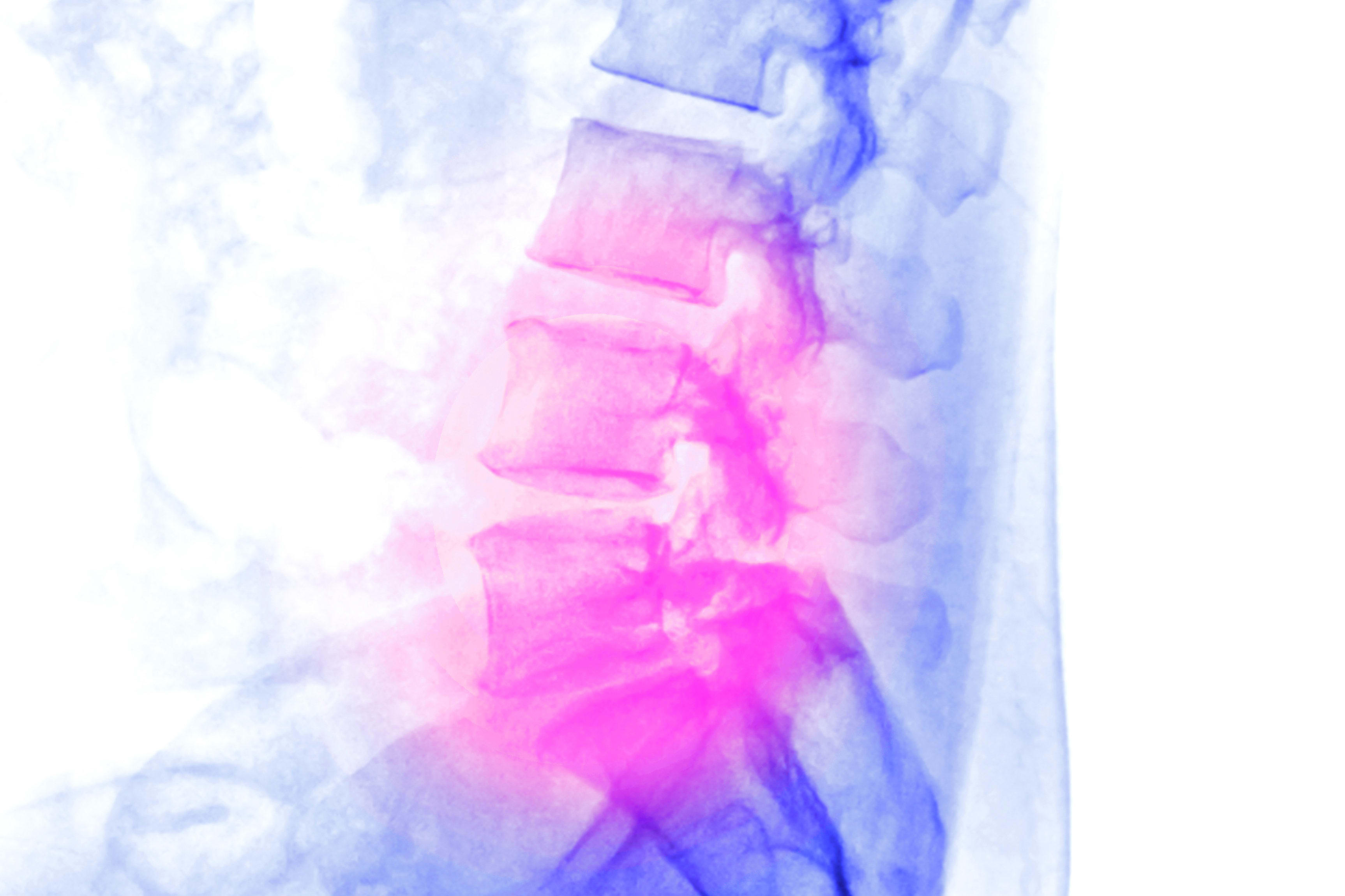 Spinal Injury Rehabilitation and Recovery | Fieldfisher