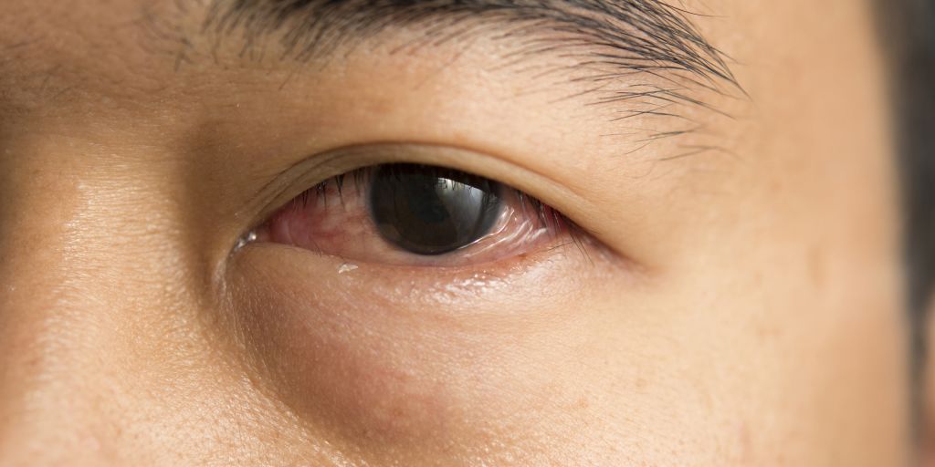 Cholesterol Deposits Around the Eyes Signals Heart Problems - Sharecare Cholesterol Deposits Around the Eyes Signals Heart Problems - Sharecare